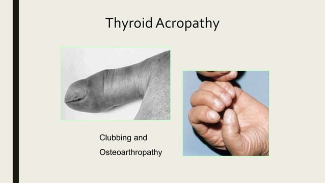 Hyperthyroidism in children | PPTX | Thyroid Disorders | Endocrine and ...