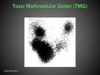 Hyperthyroidism management | PPTX