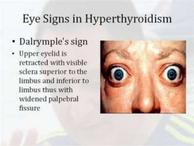 HYPERTHYROIDISM PART-2 BY DR BASHIR ASSOCIATE PROFESSOR MEDICINE SOPO…