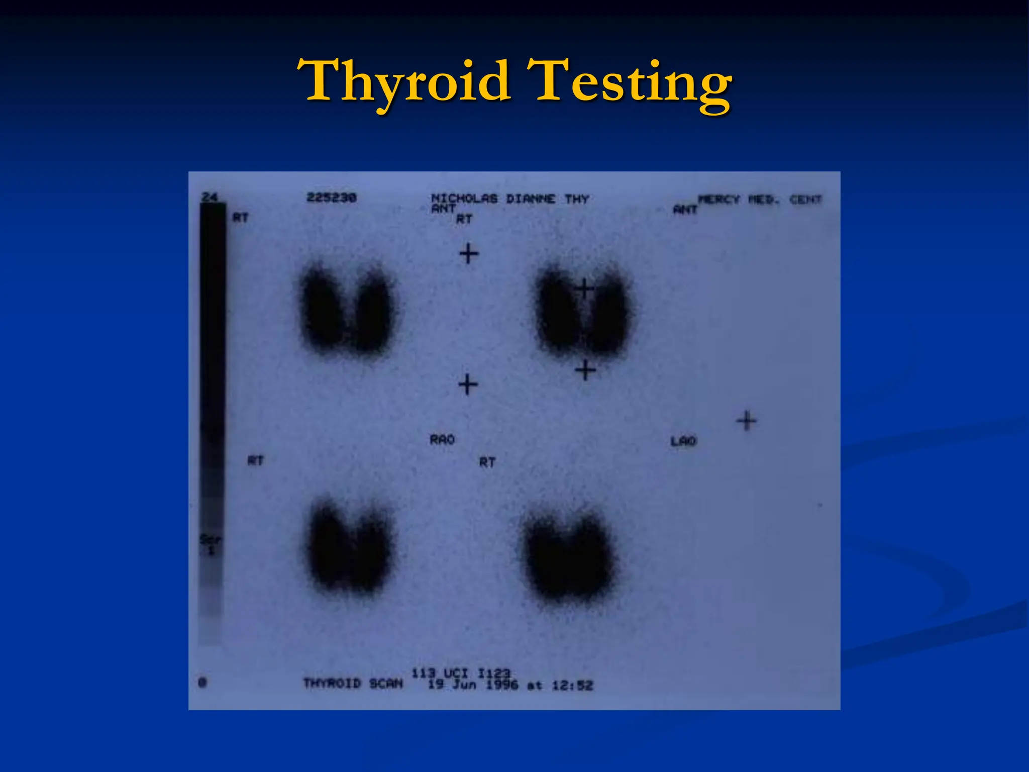 Hyperthyroidism the lect .ppt