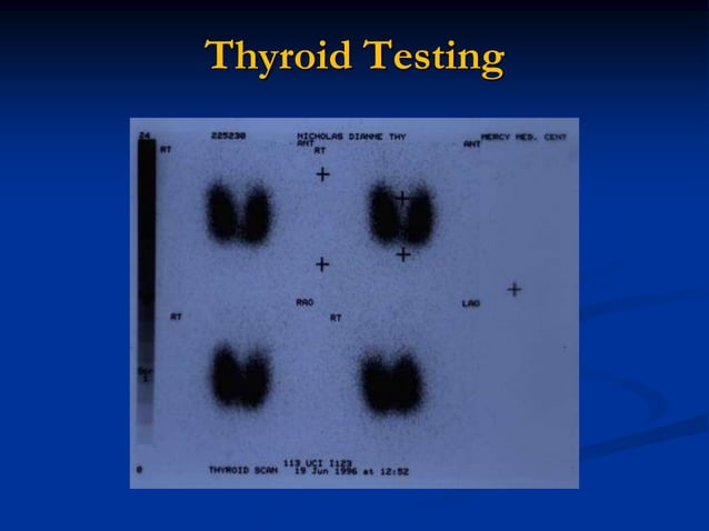 Hyperthyroidism The Lect Ppt