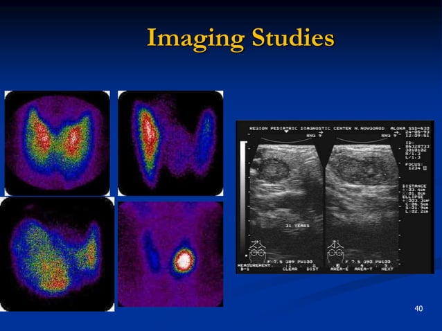 Hyperthyroidism the lect .ppt