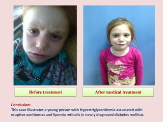 Hypertriglyceridemia in newly diagnosed d.m | PPTX