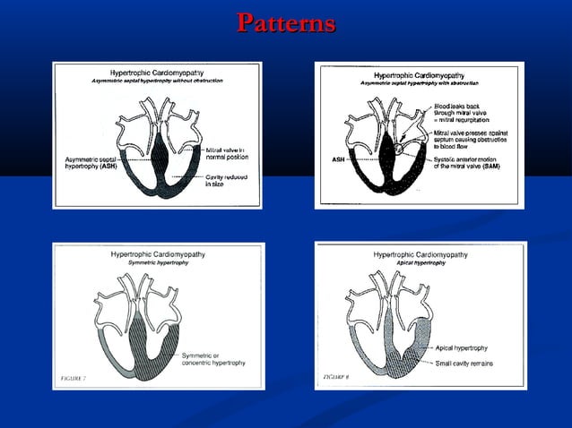 Hypertrophic cardiomyopathy | PPT