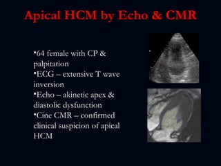 Apical Hypertrophic Cardiomyopathy Symptoms