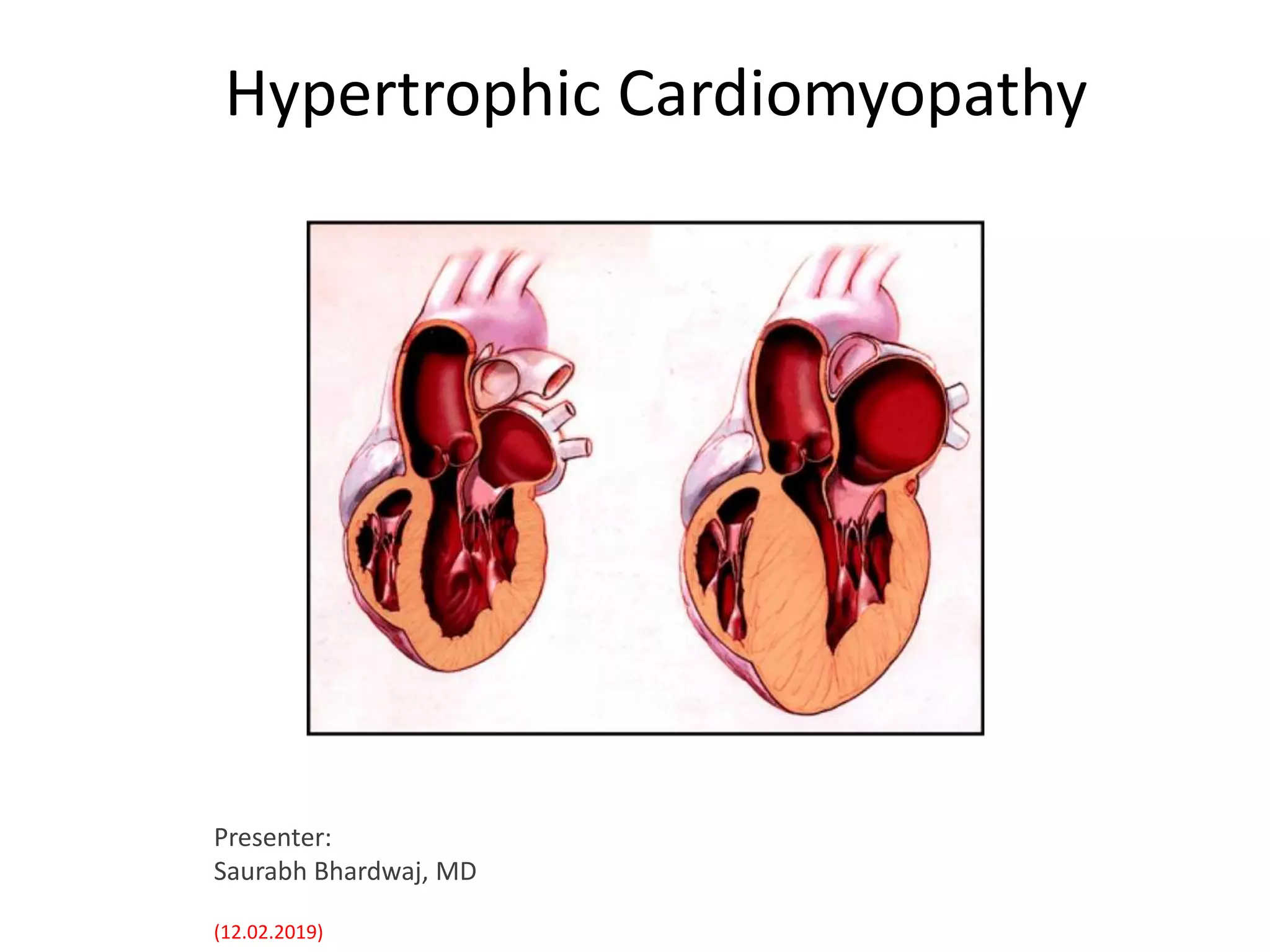 Hypertrophic cardiomyopathy | PPTX