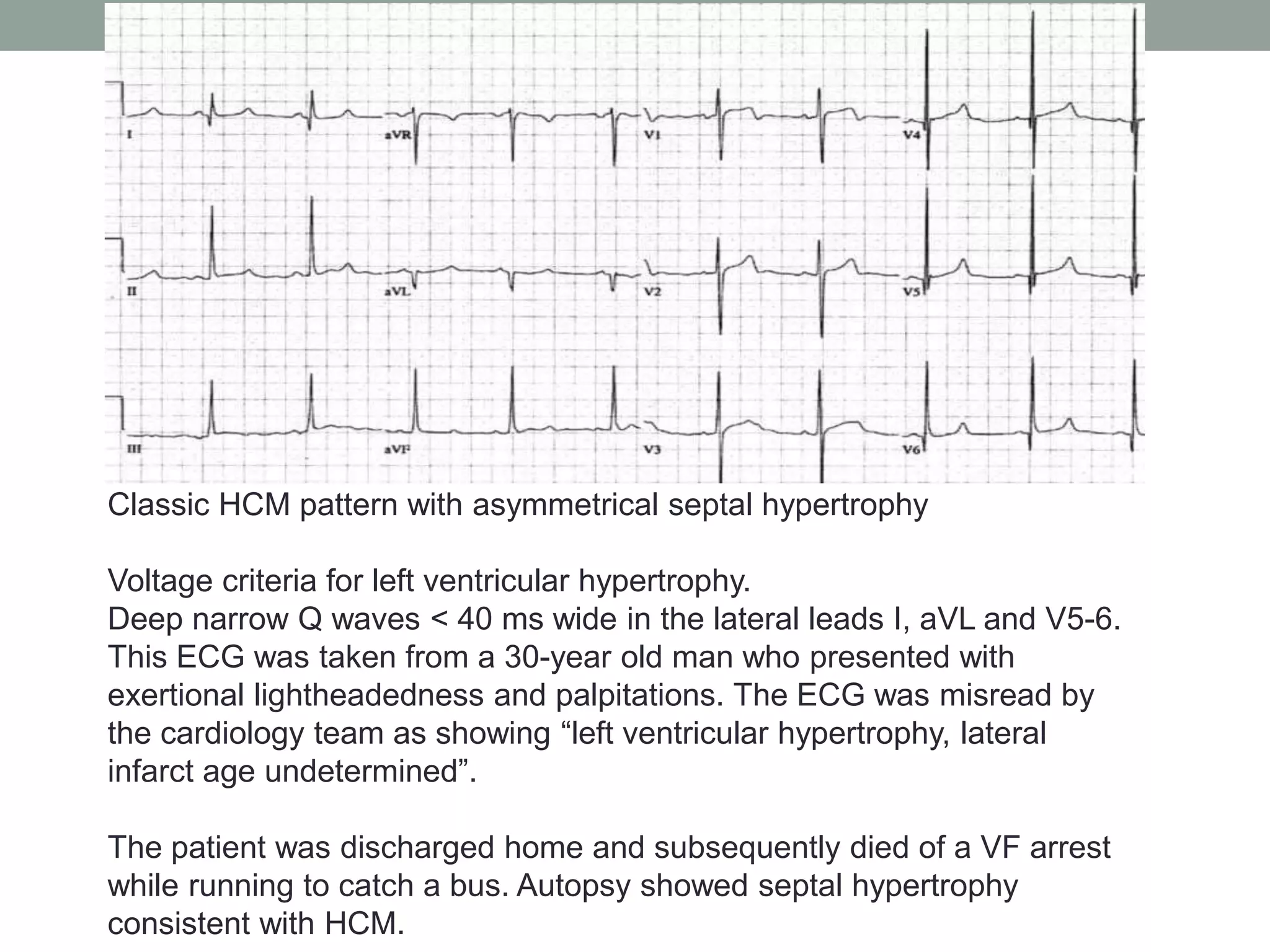 Hypertrophic Cardiomyopathy | PPTX