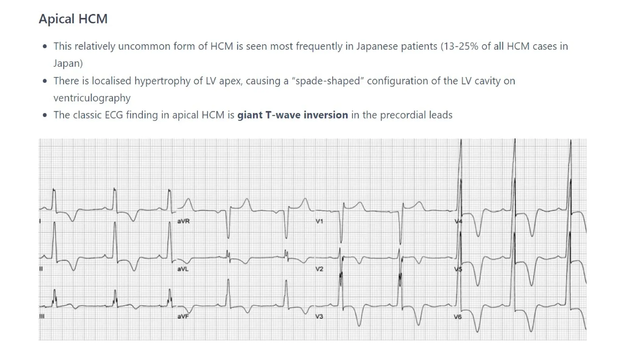 HYPERTROPHIC CARDIOMYOPATHY (HOCM): A disease of Heart | PPT