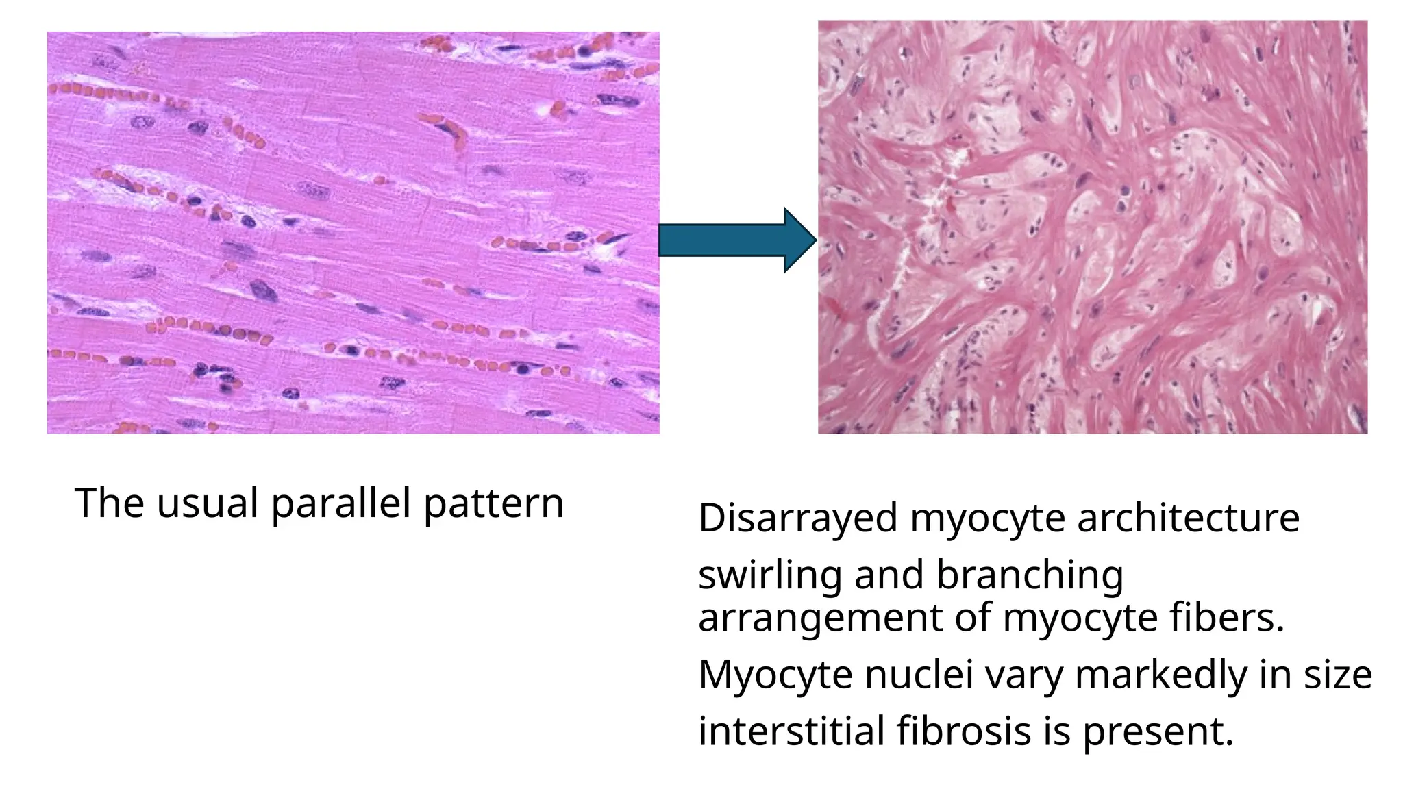 HYPERTROPHIC CARDIOMYOPATHY (HOCM): A disease of Heart | PPT