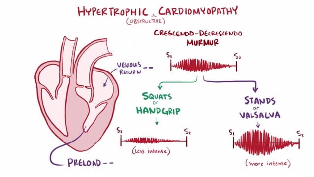 HYPERTROPHIC CARDIOMYOPATHY (HOCM): A disease of Heart | PPT