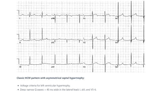 HYPERTROPHIC CARDIOMYOPATHY (HOCM): A disease of Heart | PPT