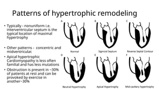 HYPERTROPHIC CARDIOMYOPATHY (HOCM): A disease of Heart | PPT