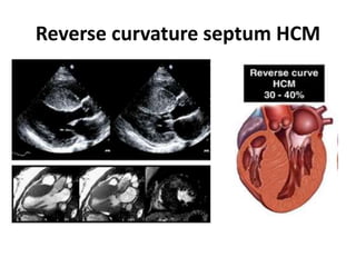 Hypertrophic cardiomyopathy | PPTX