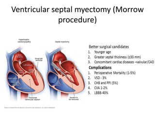 Hypertrophic cardiomyopathy | PPTX