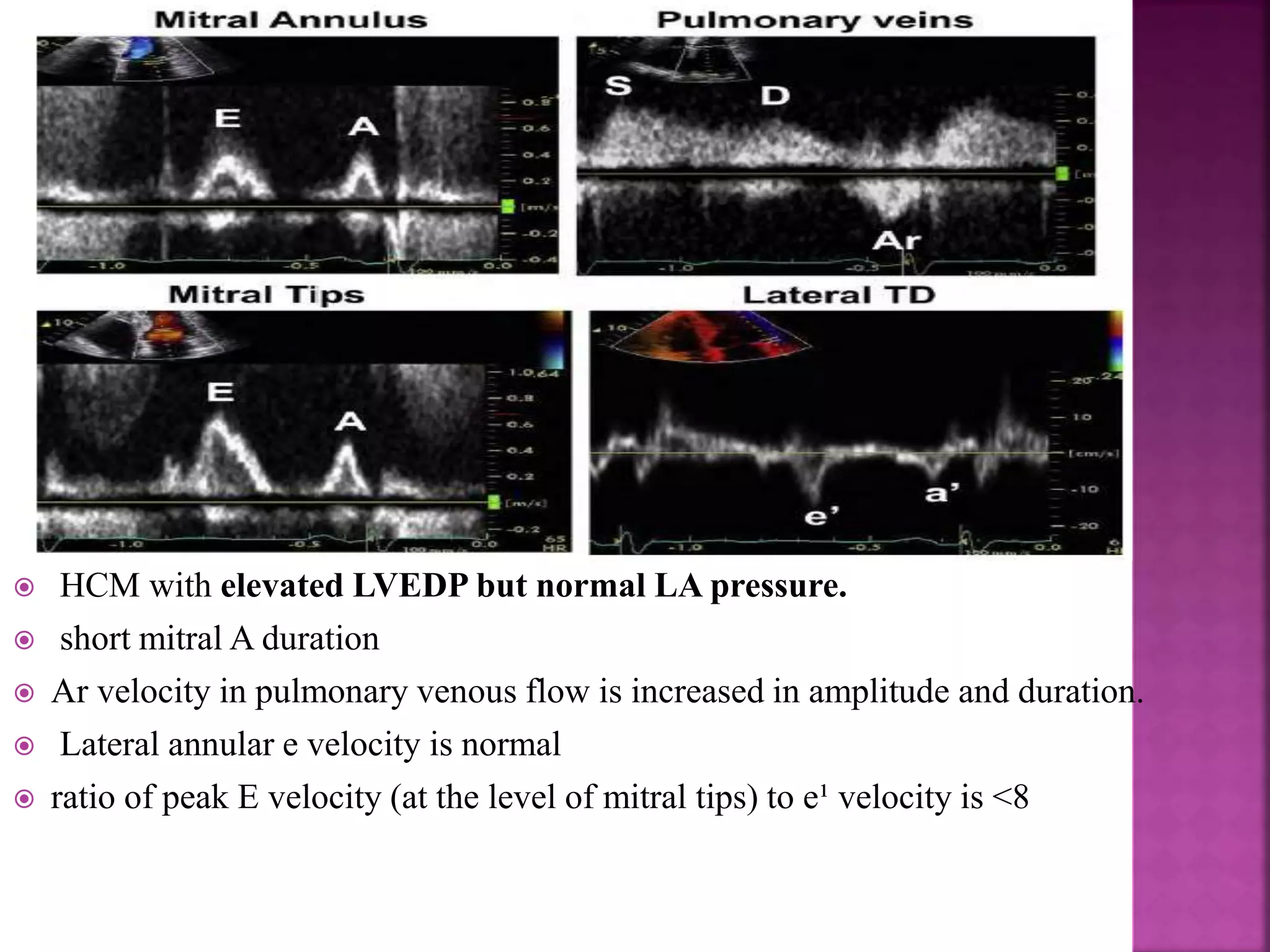 Hypertrophic cardiomyopathy (HCM) | PPTX