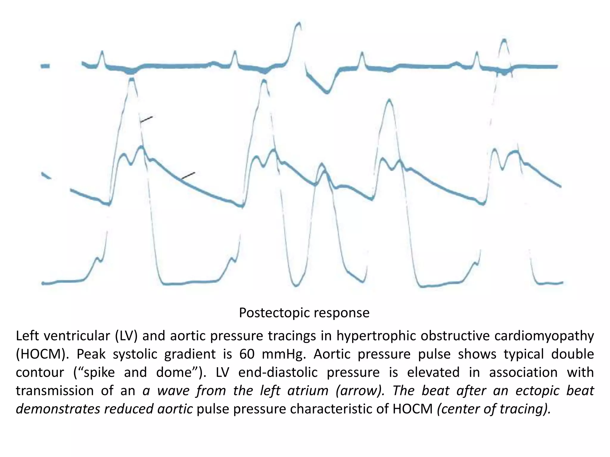 Hypertrophic obstructive cardiomyopathy | PPTX