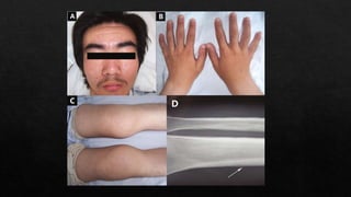 Hypertrophic pulmonary osteoarthropathy.pptx