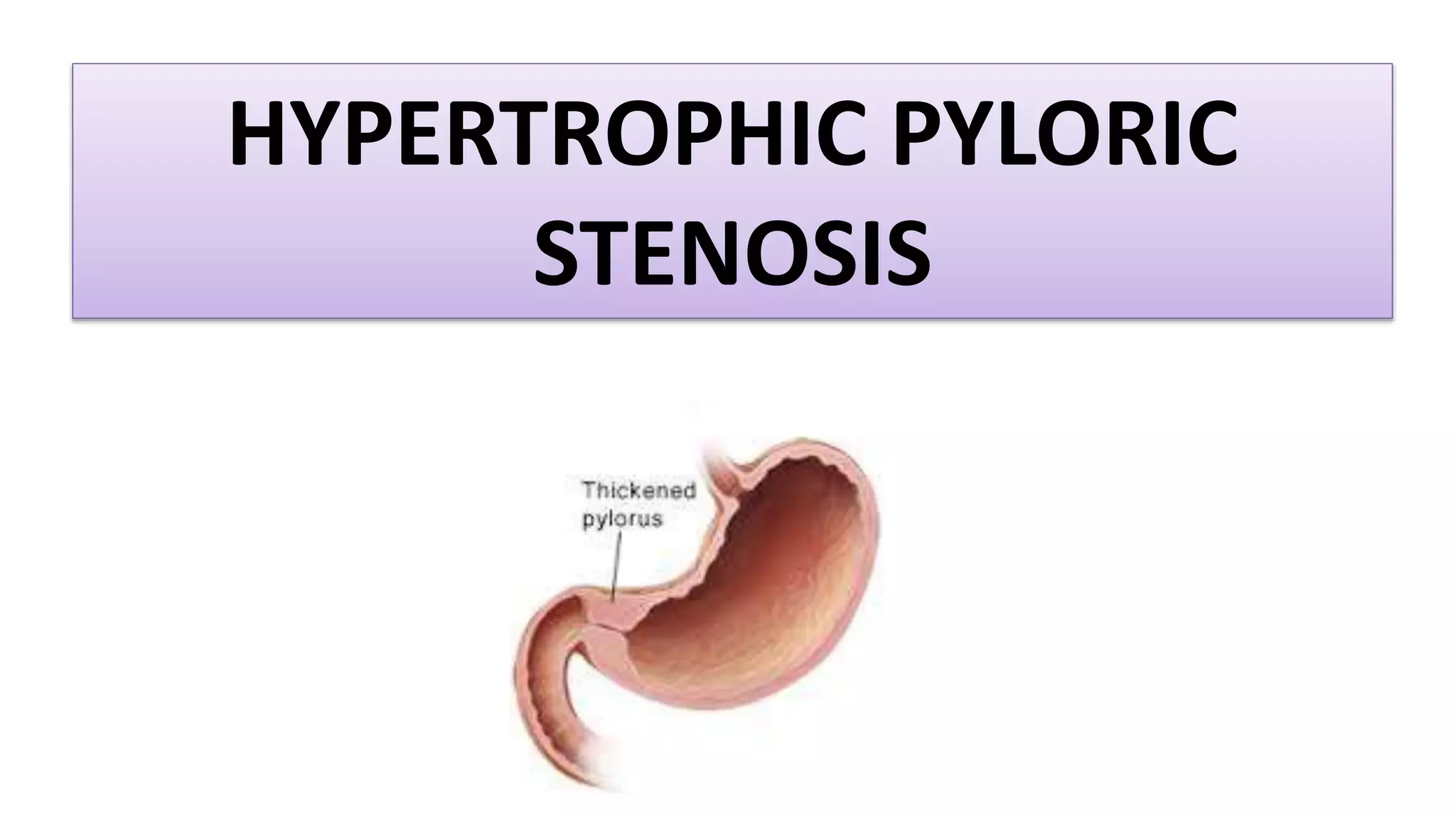 Hypertrophic Pyloric Stenosis | PPTX