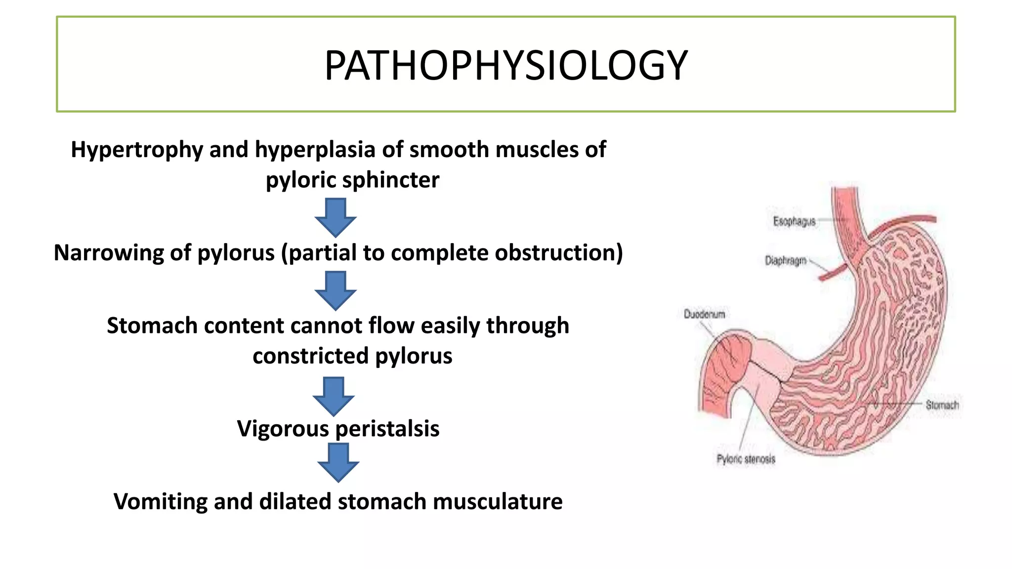 Hypertrophic Pyloric Stenosis | PPTX