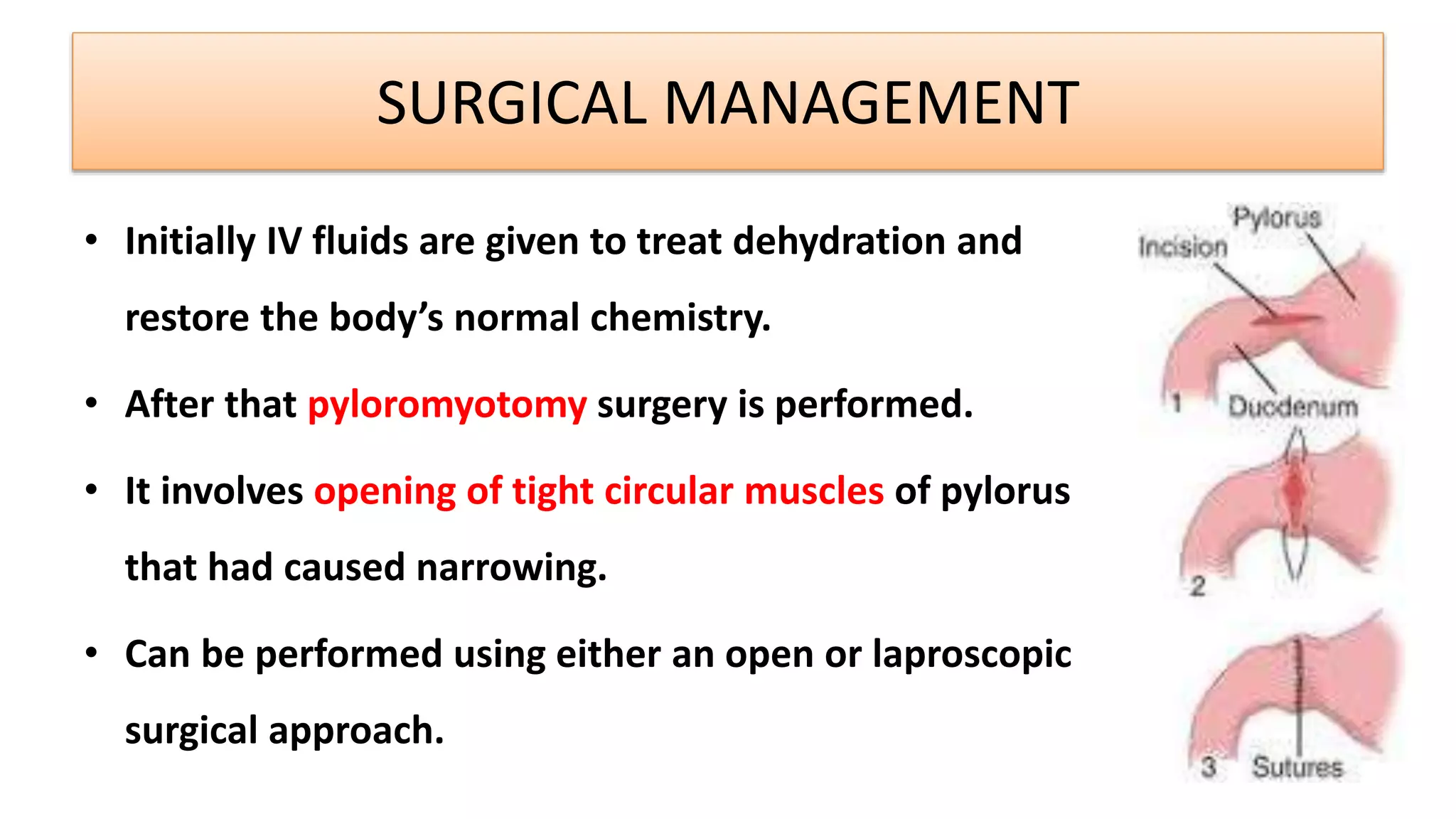 Hypertrophic Pyloric Stenosis | PPTX