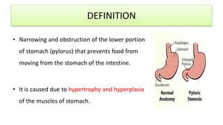 Hypertrophic Pyloric Stenosis | PPT