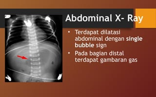 Hypertrophic Pyloric Stenosis pada bayi.ppt