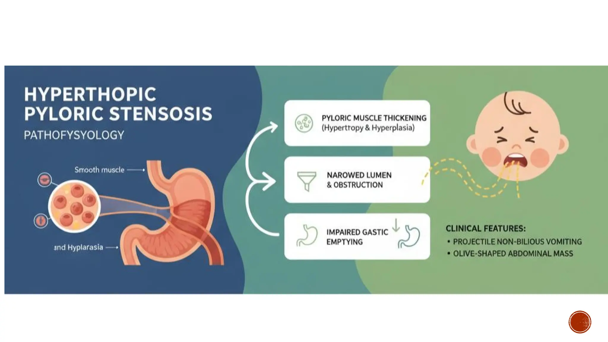 Hypertrophic Pyloric Stenosis . ppt..pptx