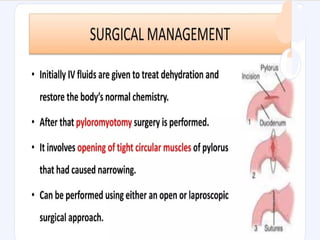 hypertrophic pyloric stenosis definition , couse, risks factors, types ...