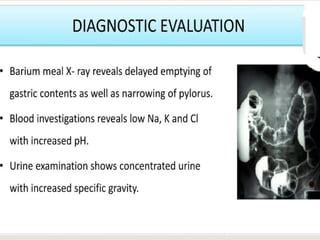 hypertrophic pyloric stenosis definition , couse, risks factors, types ...