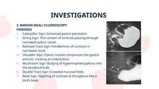 Hypertrophic Pyloric Stenosis 2025 2.pptx