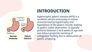 Hypertrophic Pyloric Stenosis 2025 2.pptx