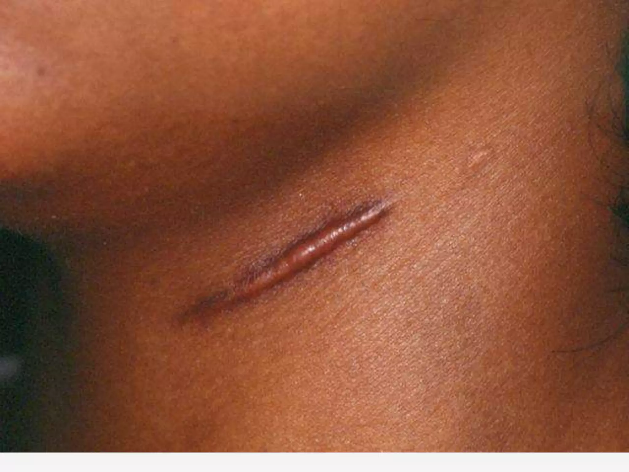 Hypertrophied scar and keloid.pptx