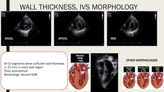 Hypertrophy Obstructive Cardiomyopathy.pptx