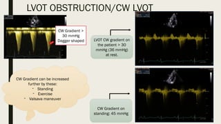 Hypertrophy Obstructive Cardiomyopathy.pptx