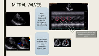 Hypertrophy Obstructive Cardiomyopathy.pptx