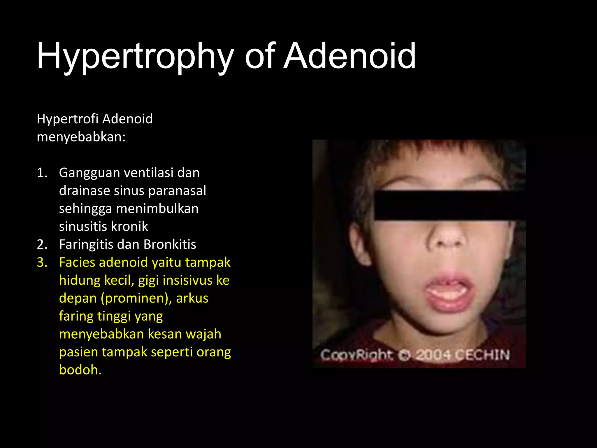 Hypertrophy of Adenoid | PPSX
