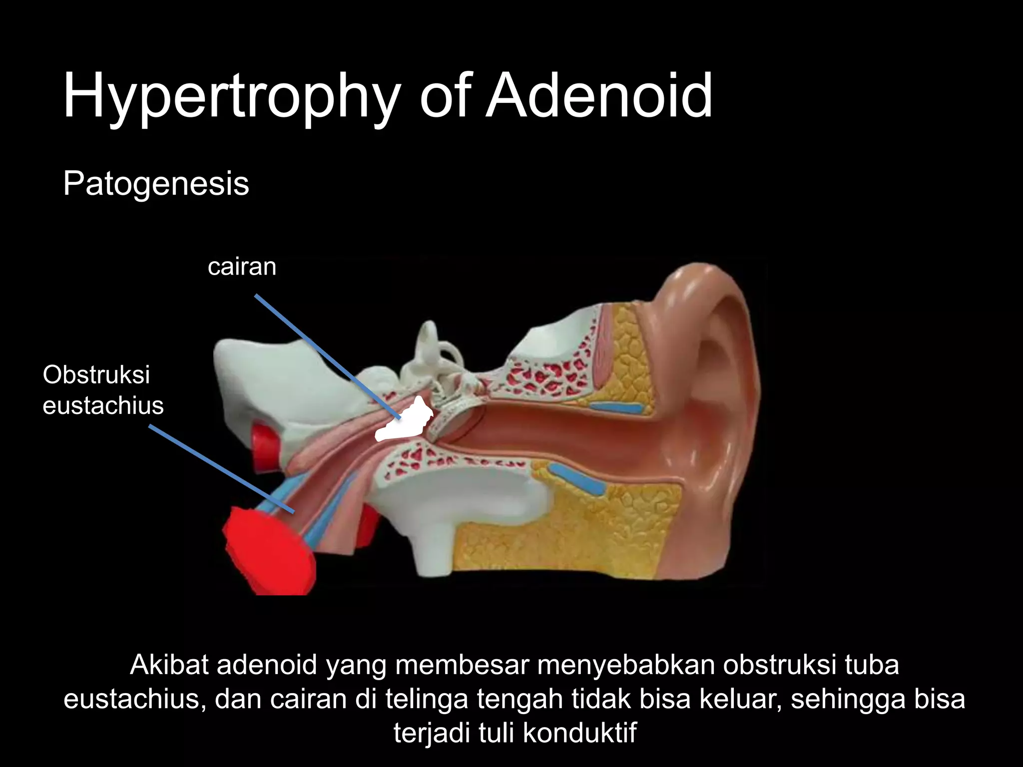 Hypertrophy of Adenoid | PPSX