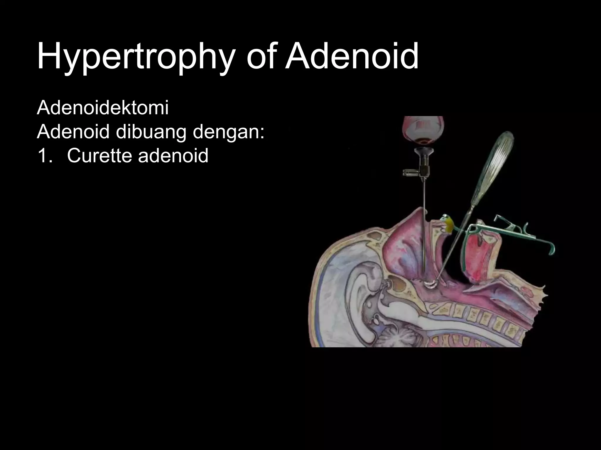 Hypertrophy of Adenoid | PPSX