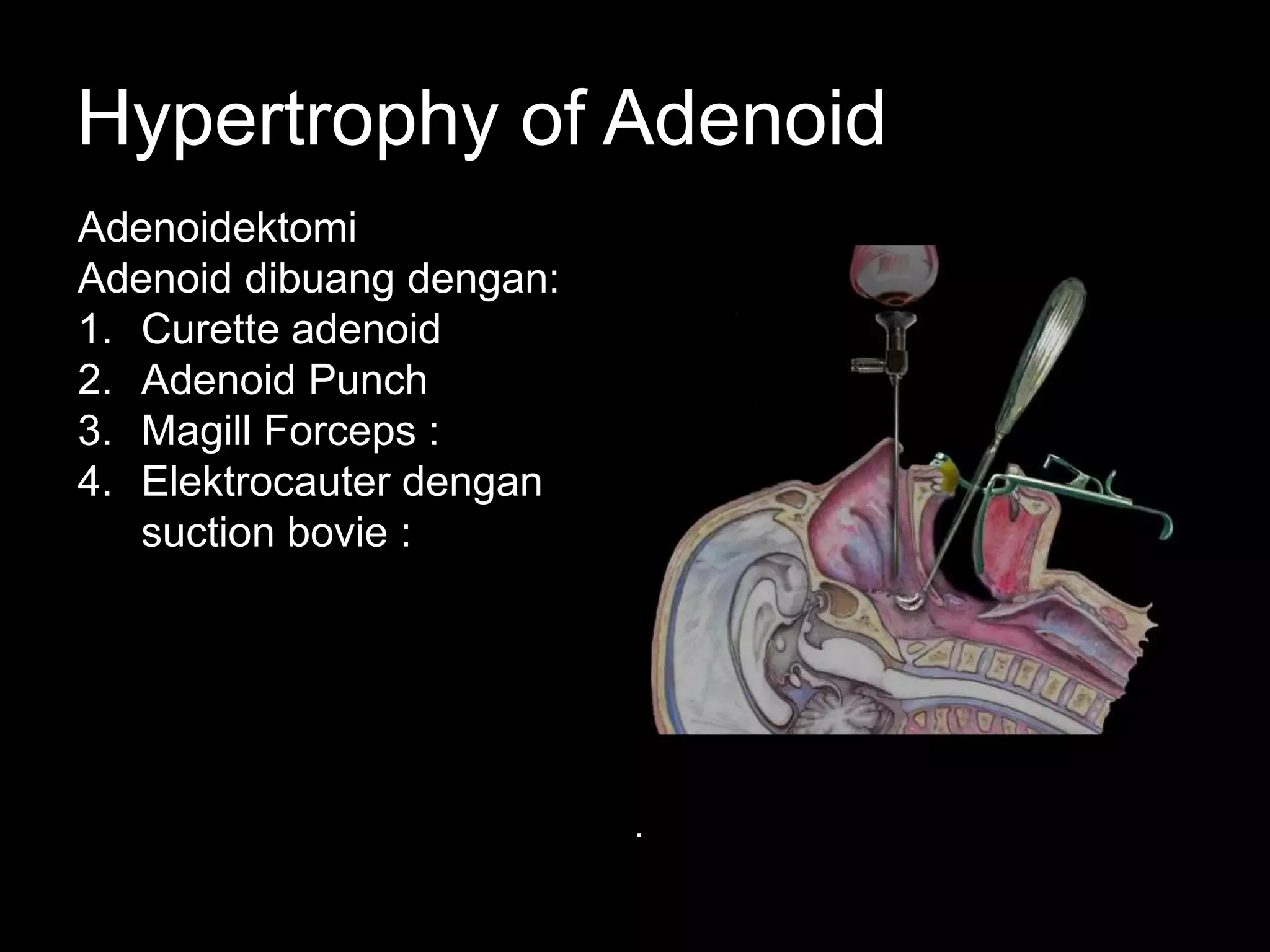 Hypertrophy of Adenoid | PPSX