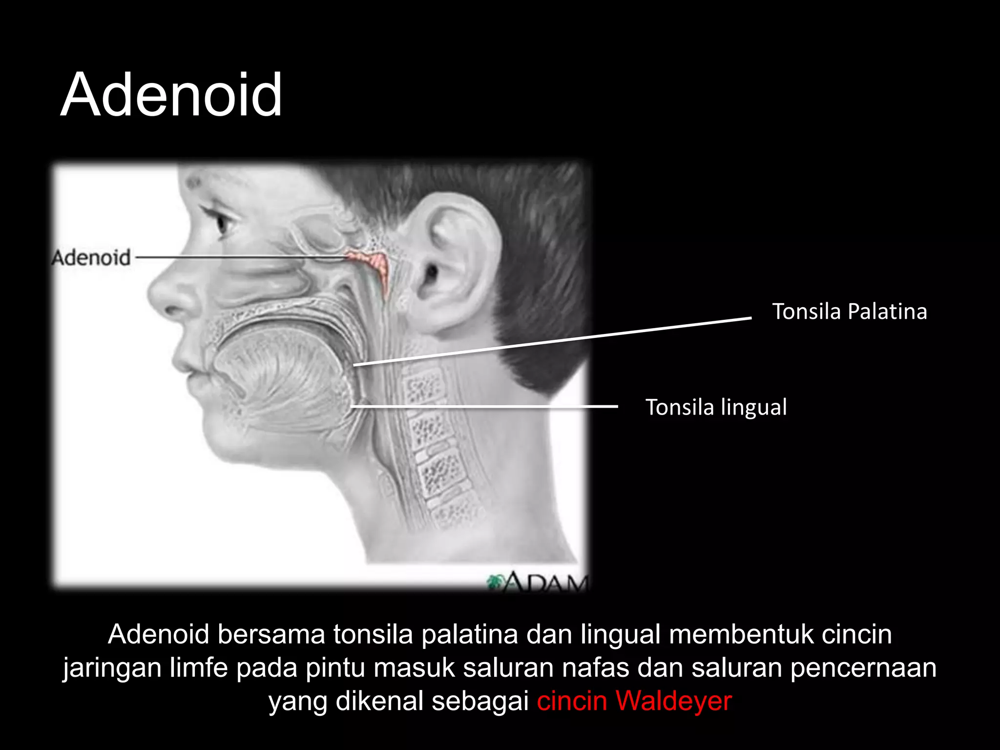 Hypertrophy of Adenoid | PPSX