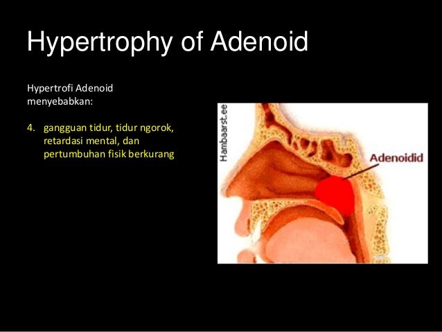 Hypertrophy of Adenoid
