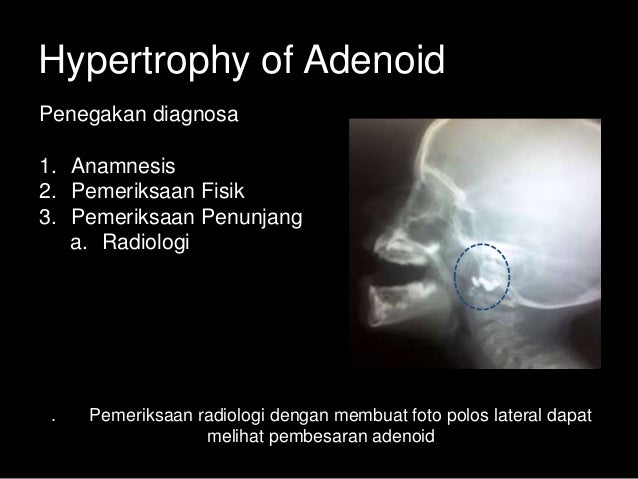 Hypertrophy Of Adenoid