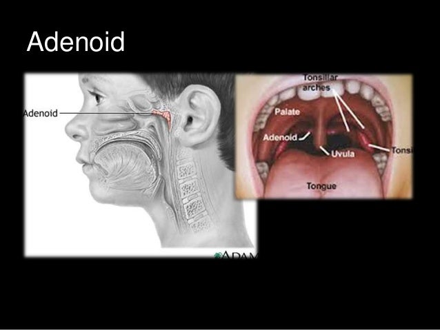 Hypertrophy of Adenoid