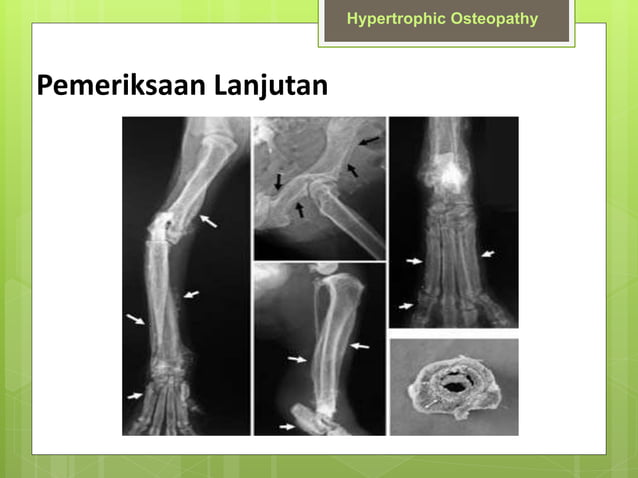 Hypertrophy osteophy | PPT