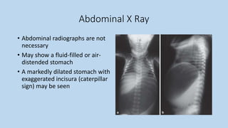 Hypertropic pyloric stenosis | PPTX