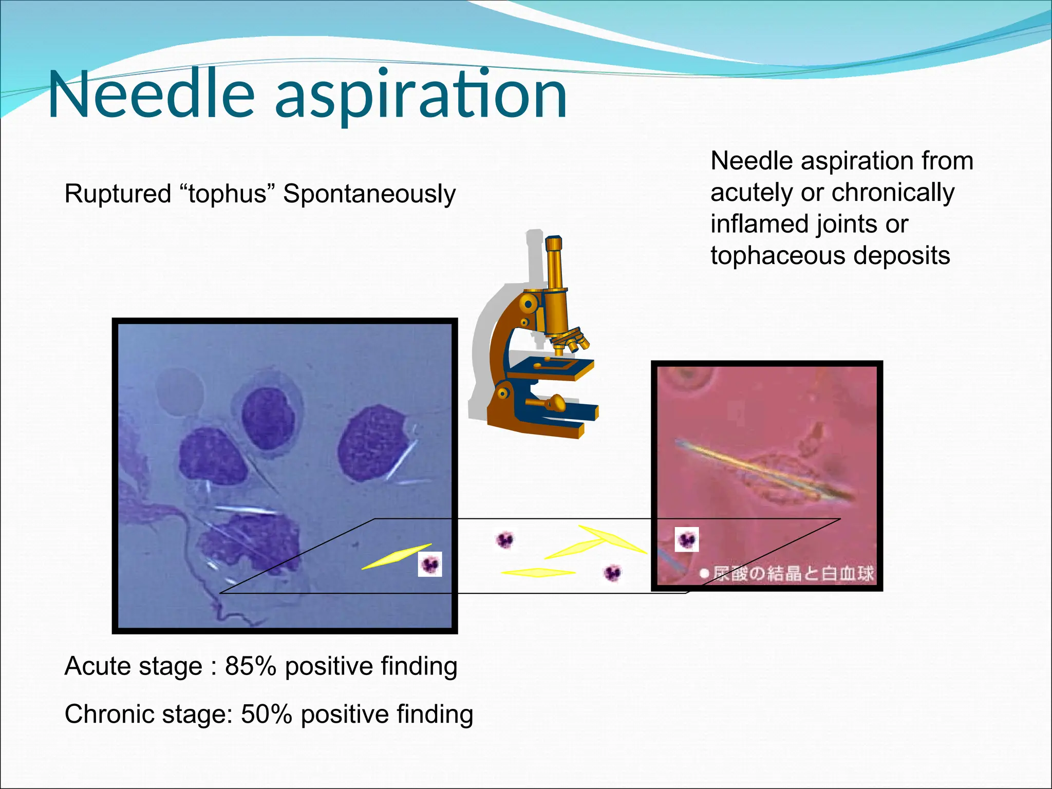 Diagnostic and treatment of Hyperuricaemia & Gout.ppt