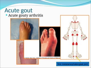 Diagnostic and treatment of Hyperuricaemia & Gout.ppt