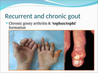 Diagnostic and treatment of Hyperuricaemia & Gout.ppt