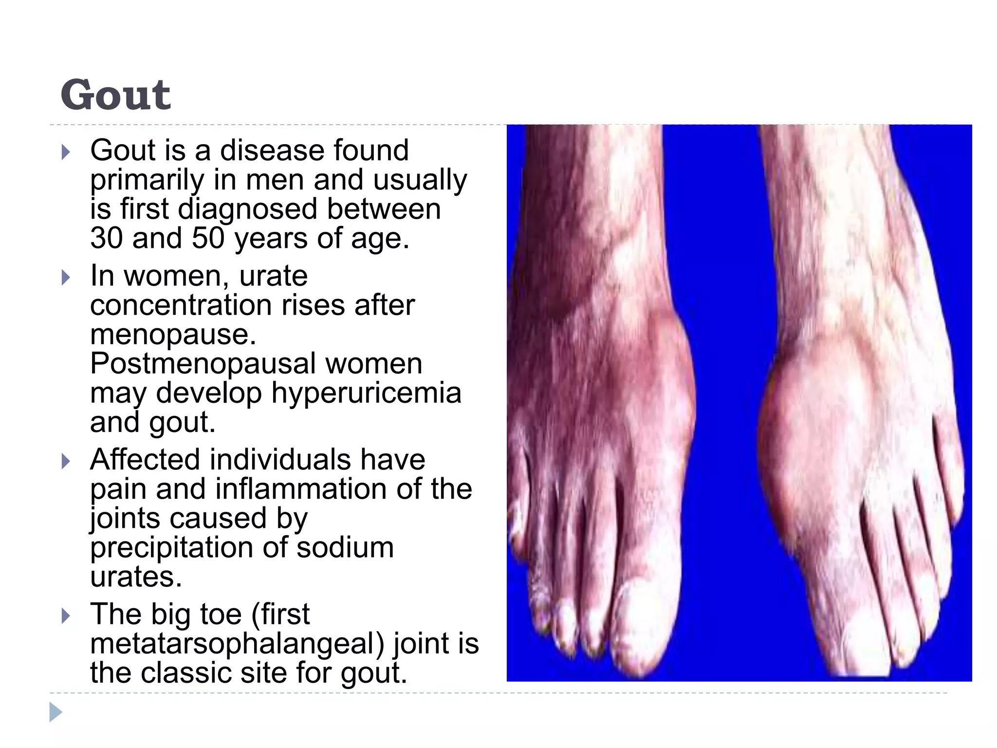Hyperuricemia | PPTX
