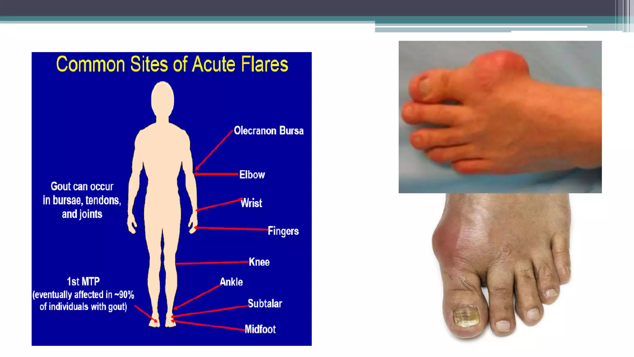 Hyperuricemia and Gout | PPTX